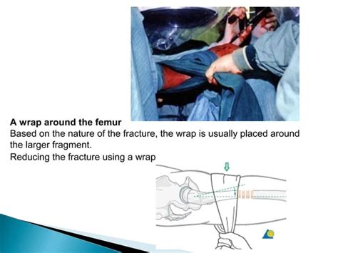 Teknik Operasi Orif Femur Ppt