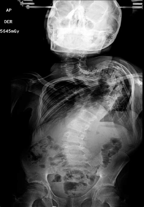 Ap Radiograph Cobb Thoracic Vertebral Angle 110 ° Source Author
