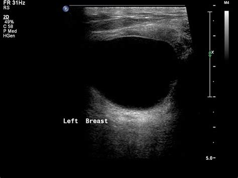 Atlas Of Breast Cancer Early Detection