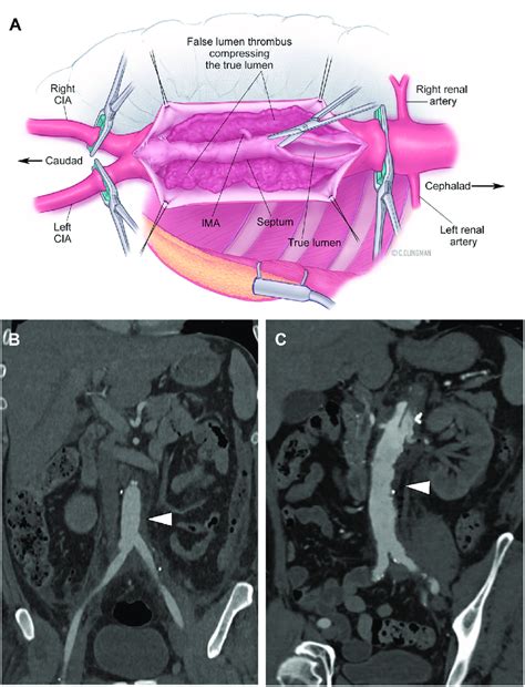 A Illustration Of Open Aortic Septectomy After Lateral Aortotomy