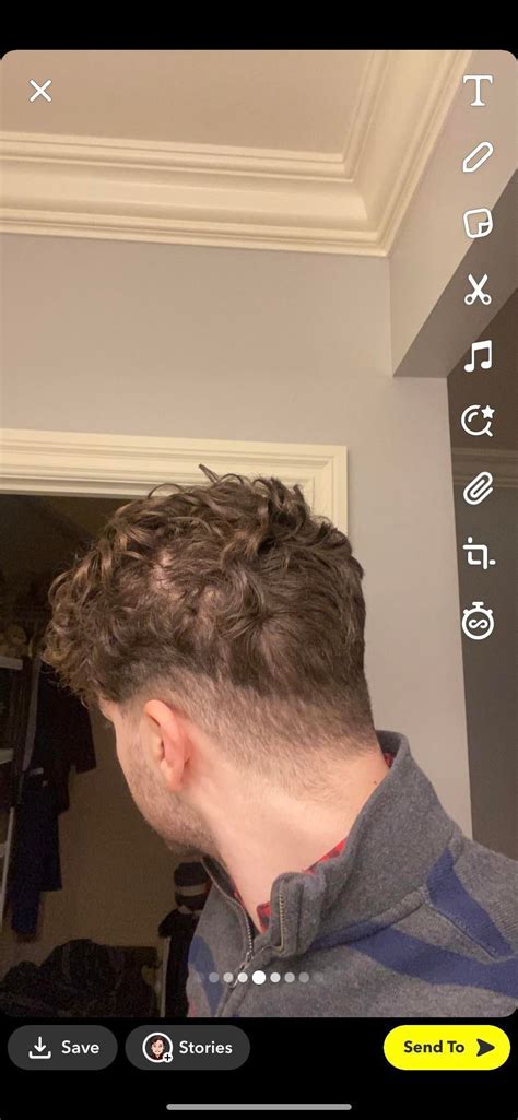 Te Diagnosis R Telogeneffluvium