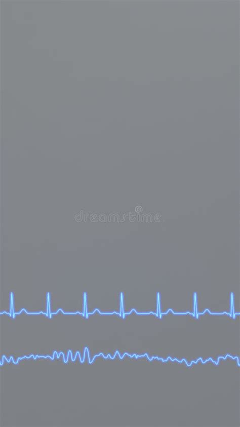 Normal Heart Rhythm Ecg And Ventricular Fibrillation Stock Image