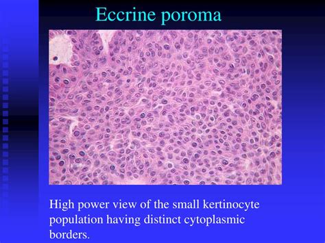 Ppt Epidermal Nevi Neoplasms And Cysts Part Iii Chapter 29 Michael