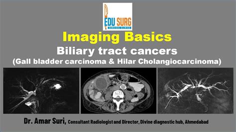 Gall Bladder Cancer And Hilar Cholangiocarcinoma Radiology Masterclass