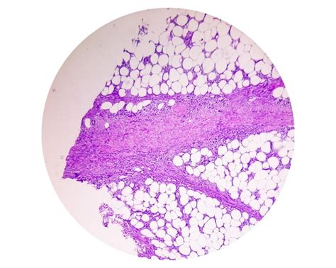 Photomicrographie De Lhistologie Du Tissu Granulomateux Montrant Un