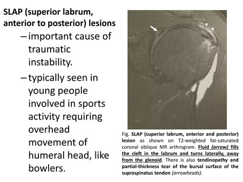 Mri Shoulder Joint With Common Pathologies Pptx