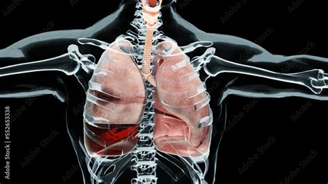 3d Illustration Of Hemopneumothorax Normal Lung Versus Collapsed