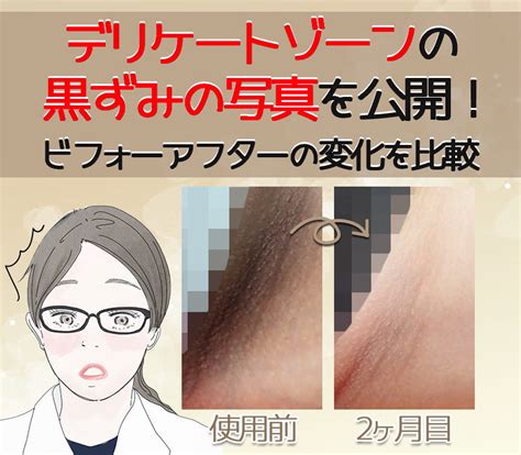 デリケートゾーン（陰部）の黒ずみを治す方法とひどい原因とは？治し方を紹介