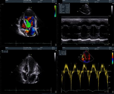 Transthoracic Echocardiography Including Tissue Doppler Showing
