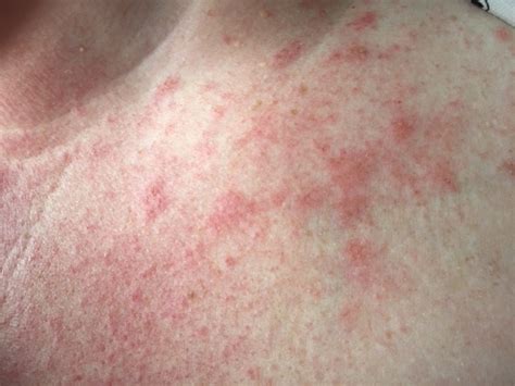 Sunlive Problematic Water Causes Skin Rash The Bays News First