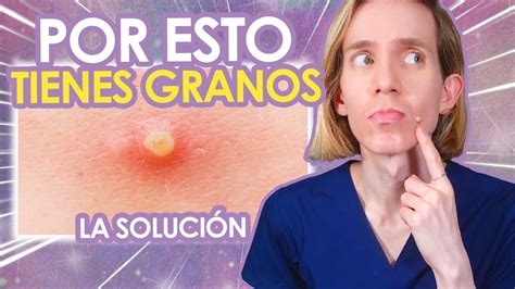 5 RAZONES Por Las Cuales TE SALEN GRANITOS Como SOLUCIONARLAS Simon