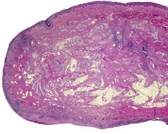 Accessory Auricle Wikipedia