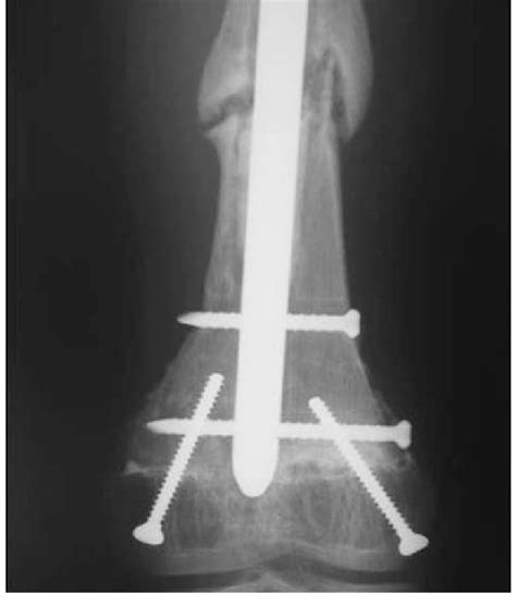 An Anteroposterior Ap Radiograph Shows The Retrograde Crossing Screws