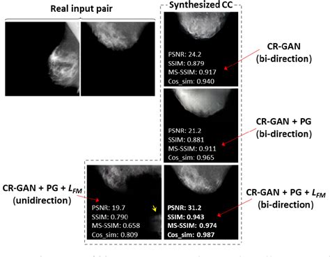 Figure 1 From Two View Mammogram Synthesis From Single View Data Using