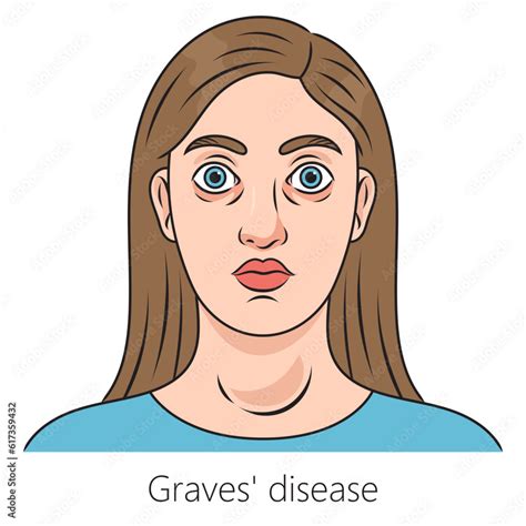 Poster Woman With Graves Disease Toxic Diffuse Goiter Diagram Schematic