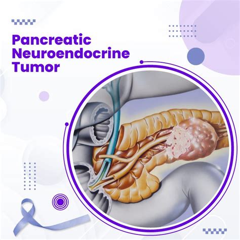 Pancreatic Neuroendocrine Tumor Uhapo