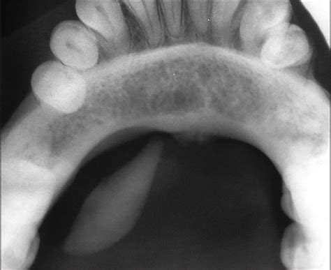 SIALOLITH OF WHARTONS DUCT Buyxraysonline