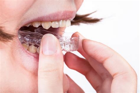Essix Retainer Cost Cleaning Care And Pros And Cons