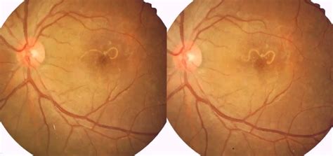 Hookworm In Human Eye How Some Parasites Can End Up In Your Eye And