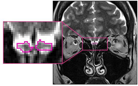 Olfactory Nerve Mri