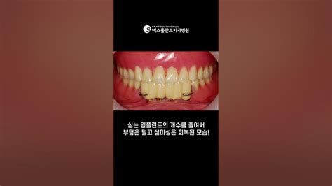 치아가 하나도 없는 완전 무치악 환자는 어떤 치료를 할 수 있을까 Shorts Youtube