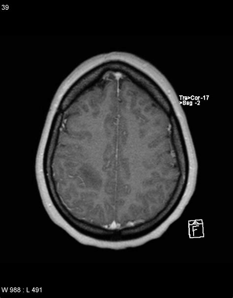 Astroblastoma Radiopaedia 39792 42217 Axial T1 C Nc Commons