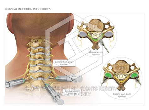 Image 10363 Im02 Cervical Facet Injections Illustration