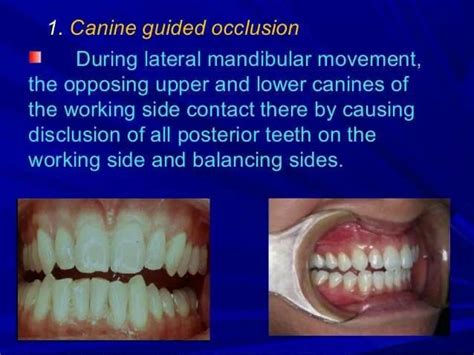 5th L Mutually Protected Occlusionpptx