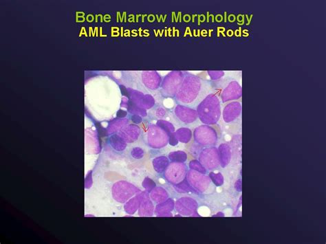 Ppt Pediatric Acute Myelogenous Leukemia Aml Powerpoint