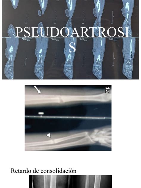 Pseudoartrosis Pdf