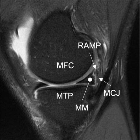 Magnetic Resonance Imaging Mri Classification Of Ramp Lesions