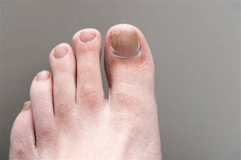 640 Manchas Blancas En Las Uñas De Los Pies Fotografías De Stock