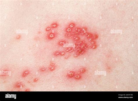 Close Up Of A Rash Of Blisters Papules On The Skin Of A 2 Year Old