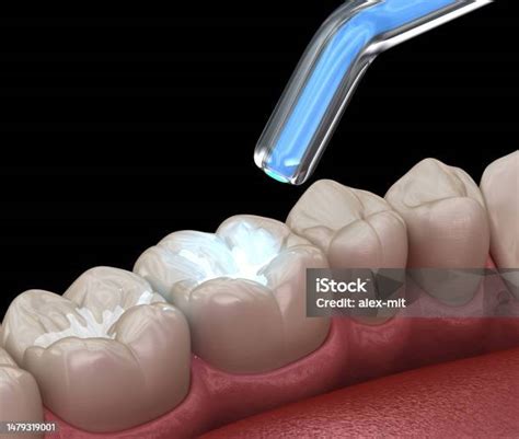 충전 및 중합 램프로 치아 복원 치과용 3d 일러스트레이션 3차원 형태에 대한 스톡 사진 및 기타 이미지 3차원 형태 Led 조명 건강관리와 의술 Istock