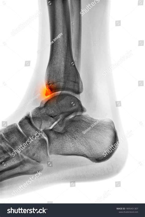 Tibial Spur X Ray Offset Collection Stock Illustration 1895451307
