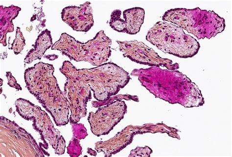 Reactive Mesothelial Cells