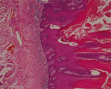 Oral Proliferative Verrucous Leukoplakia H And E ×100 Section Shows Download Scientific