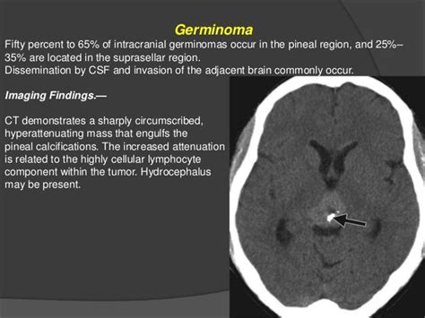 Pineal Region Masses Radiology