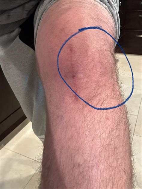 Knee Effusion Post Surgery Racl