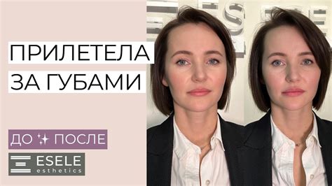 СДЕЛАЛА ГУБЫ КАК ПРОХОДИТ ПРОЦЕДУРА УВЕЛИЧЕНИЯ ГУБ Как правильно