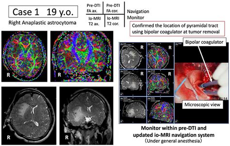 Frontiers Combining Pre Operative Diffusion Tensor Images And