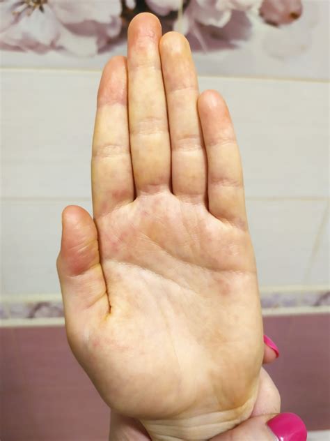 Пятна на ладони у ребёнка У дочки 9 лет пятна на ладонях Подушечки Medaboutme