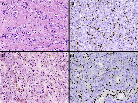 Squamous Cell Carcinoma Of The Eyelid