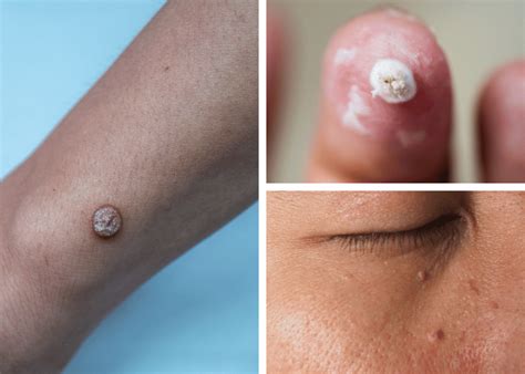 Verruca Vulgaris Warts Silkee Skin And Hair Clinic