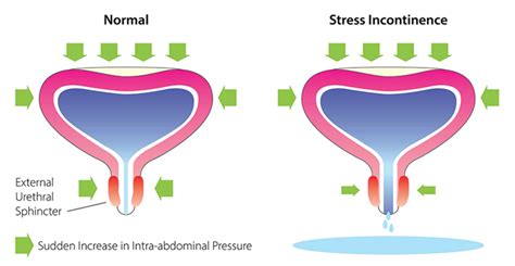 Fyzical Rockville Stress Urinary Incontinence Sui Symptoms And
