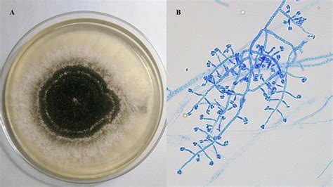 Skin Infection Due To Trichoderma Longibrachiatum In A Haematological