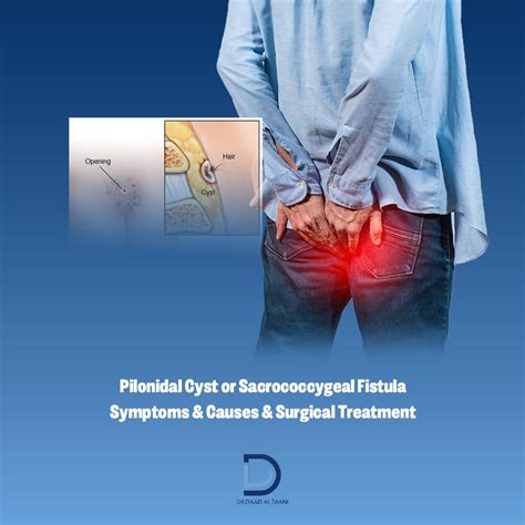 Pilonidal Sinus Causes Symptoms And Treatment د دعد الطعاني