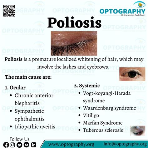 Poliosis
