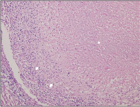Histological Finding Of Peritoneal Wall Peritoneal Biopsy Shows