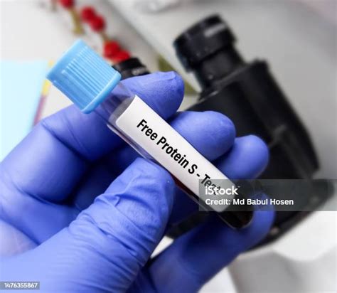 응고 장애의 진단에 유리 단백질 S 검사를위한 혈액 샘플 폐색전증 단백질 S 결핍 0명에 대한 스톡 사진 및 기타 이미지 0명 개념 개념과 주제 Istock